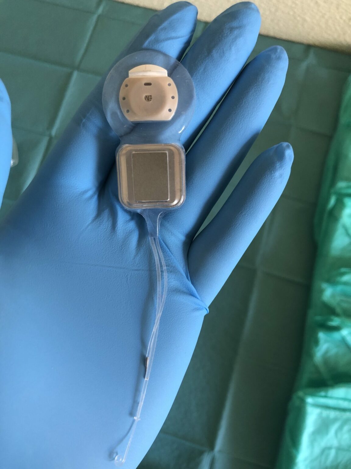 Implante Coclear - Felippe Felix