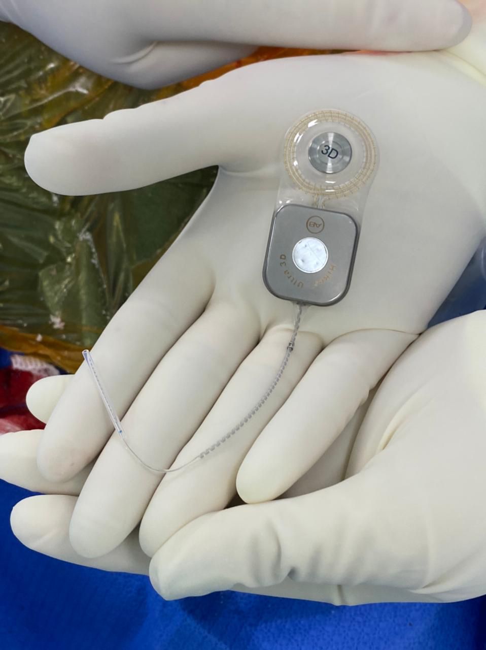 IMPLANTE COCLEAR: a tecnologia que transforma vidas - Felippe Felix