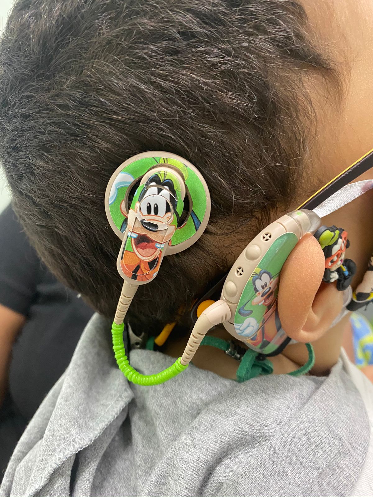 IMPLANTE COCLEAR: a tecnologia que transforma vidas - Felippe Felix